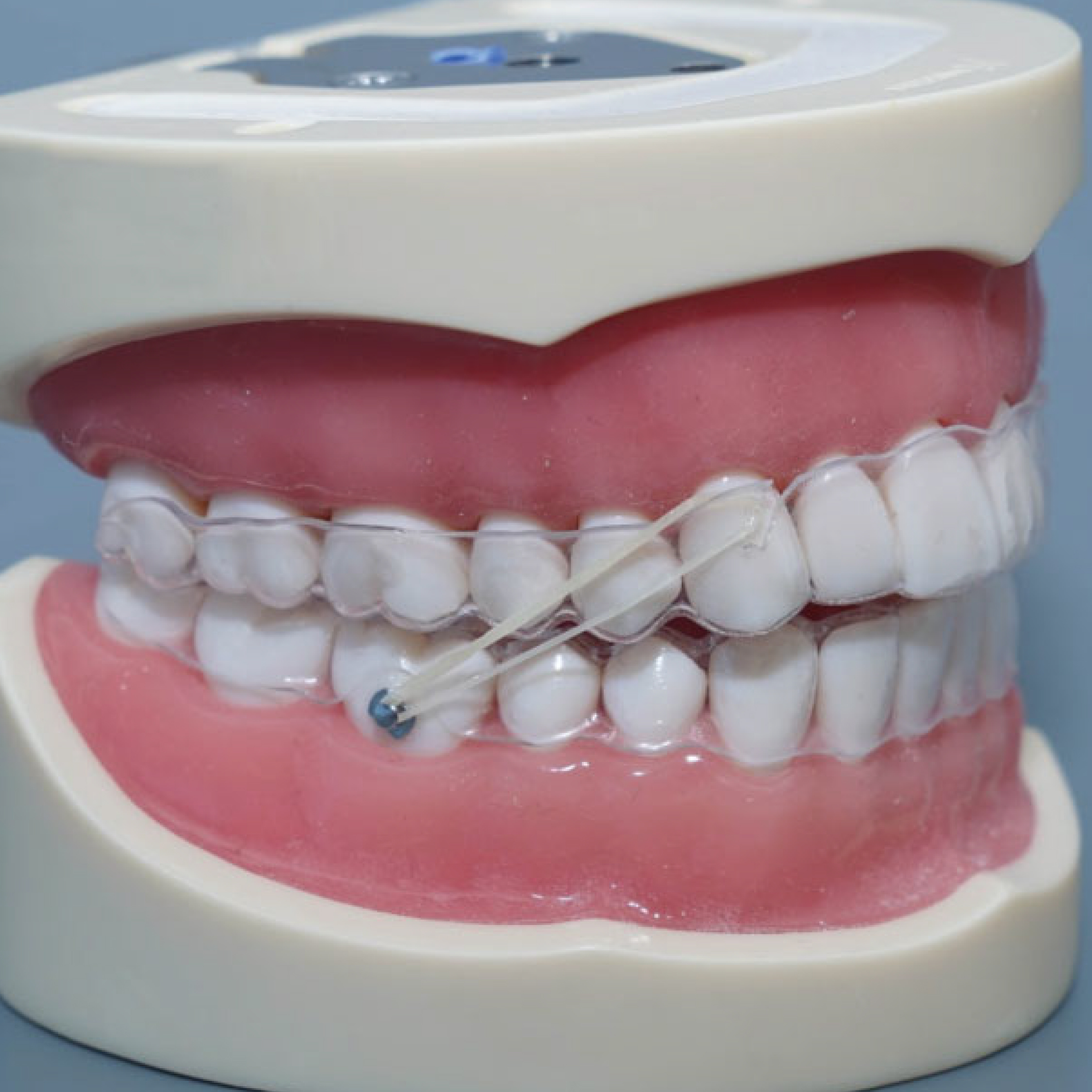Class II Malocclusion with Clear Aligners: How to Successfully Treat Your Patients